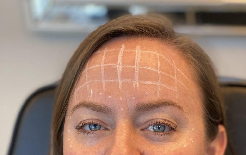 Everything you need to know about Botox | My Experience + Botox Facts