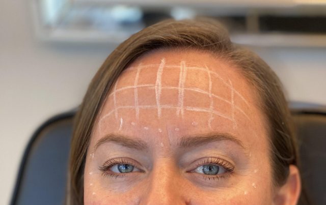 Everything you need to know about Botox | My Experience + Botox Facts